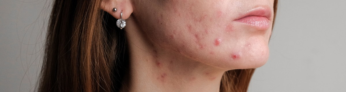 ¿Brotes de acné? Causas y solución – NAÁY